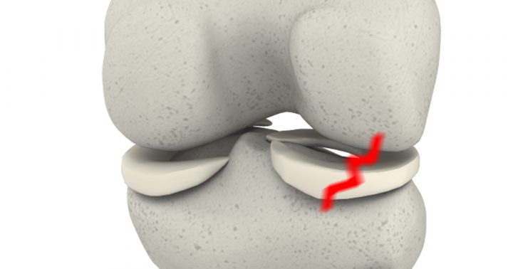 Meniskusriss | Was Sie wissen sollten | knorpelexperte.de