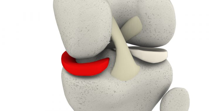 Innenmeniskus | Probleme, Hilfe & Therapie | knorpelexperte.de